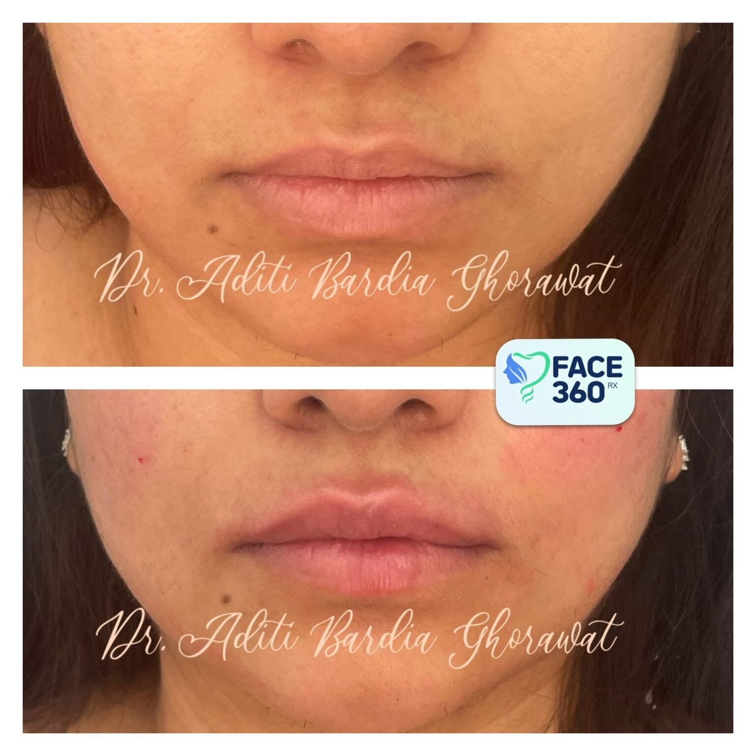 Cheiloplasty (Lip Surgery) the Best in Indore | Face 360x